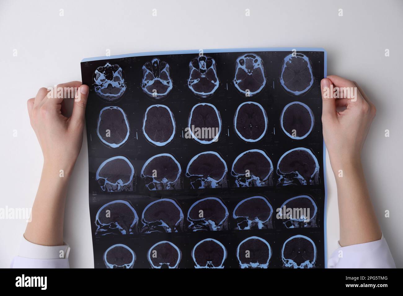Doctor examining MRI images of patient with multiple sclerosis at white ...