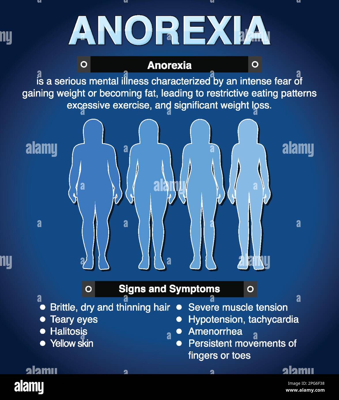 Informative poster of Anorexia eating disorder illustration Stock ...