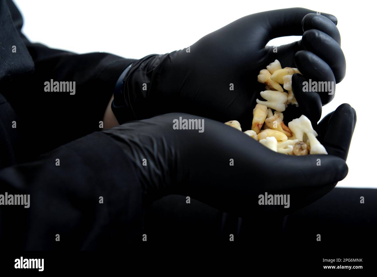 close-up handful of teeth in hands of black latex gloves caries pull ...