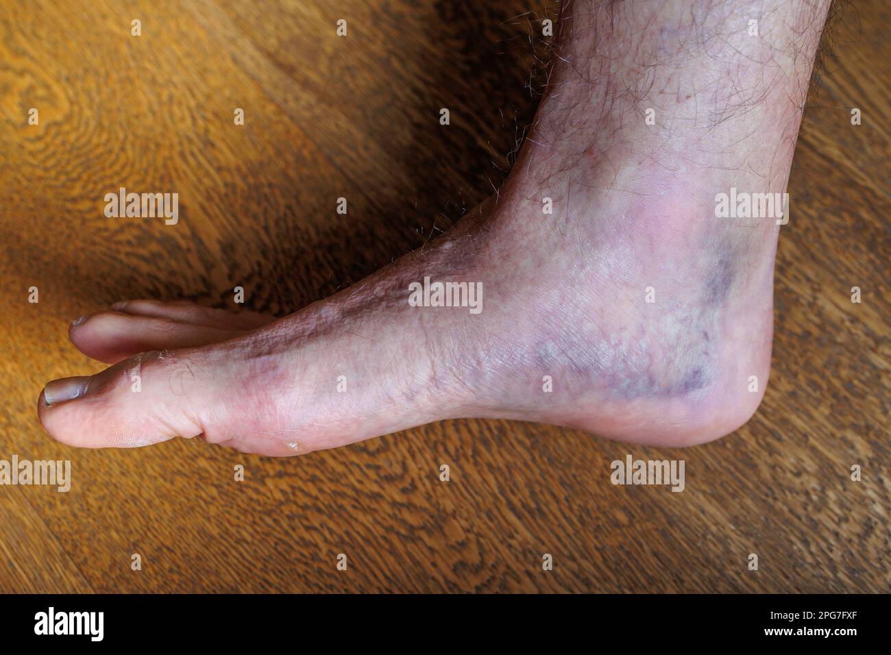 Large Bruise in the Heel of the Foot after a Stretching Injury Stock ...