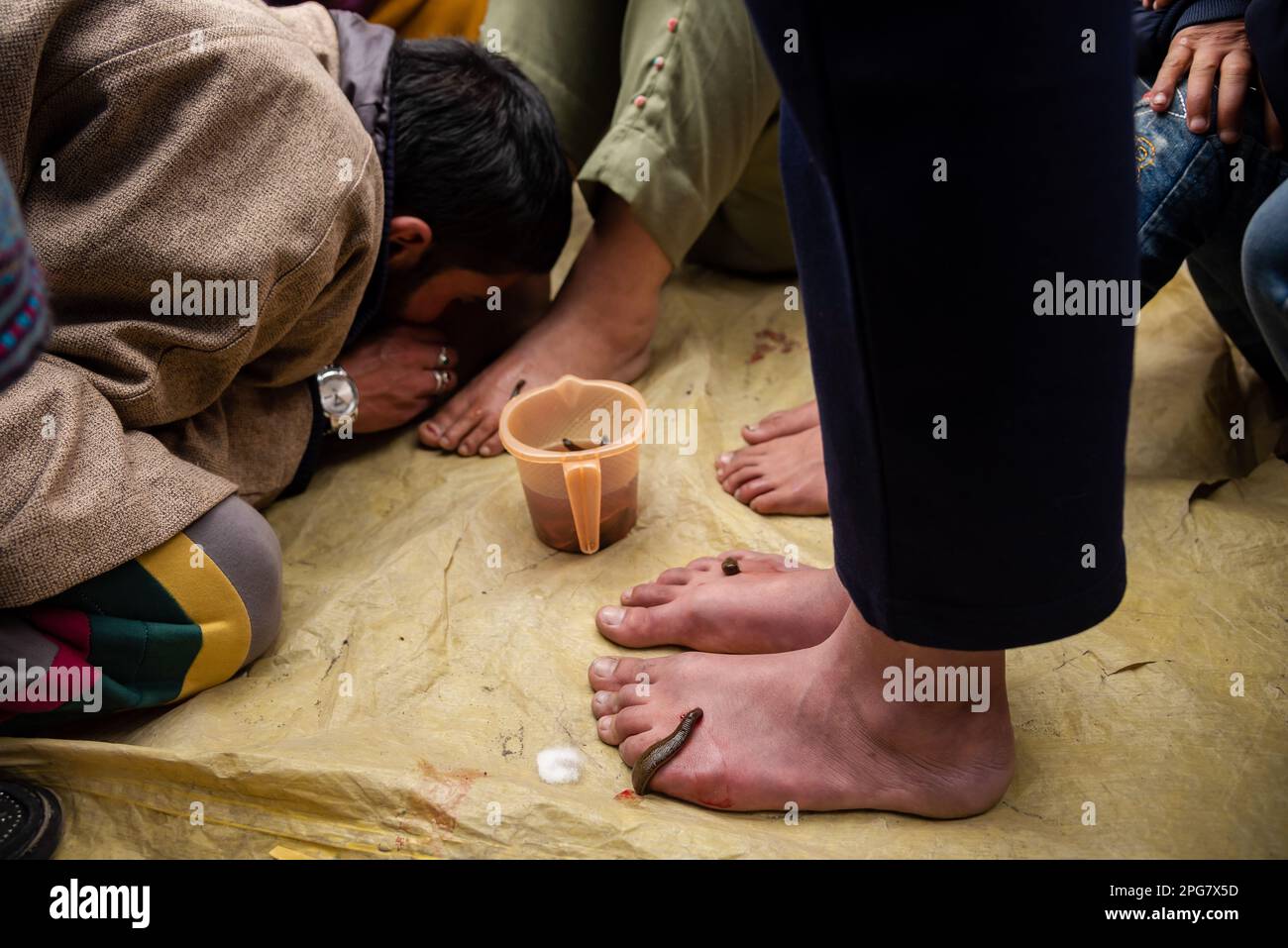 Srinagar, India. 21st Mar, 2023. Residents receive leech treatment on ...