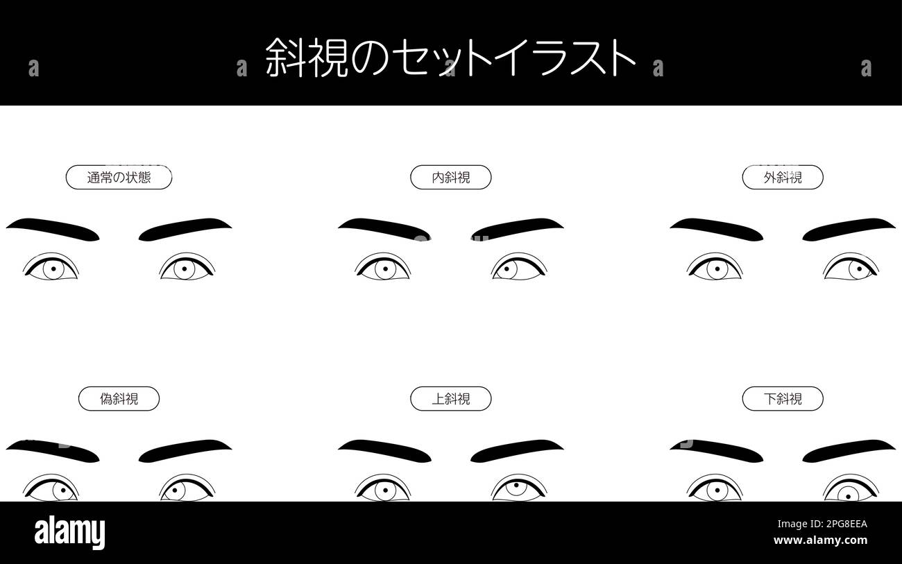 Medical illustration, Illustrative set eye diseases and strabismus ...