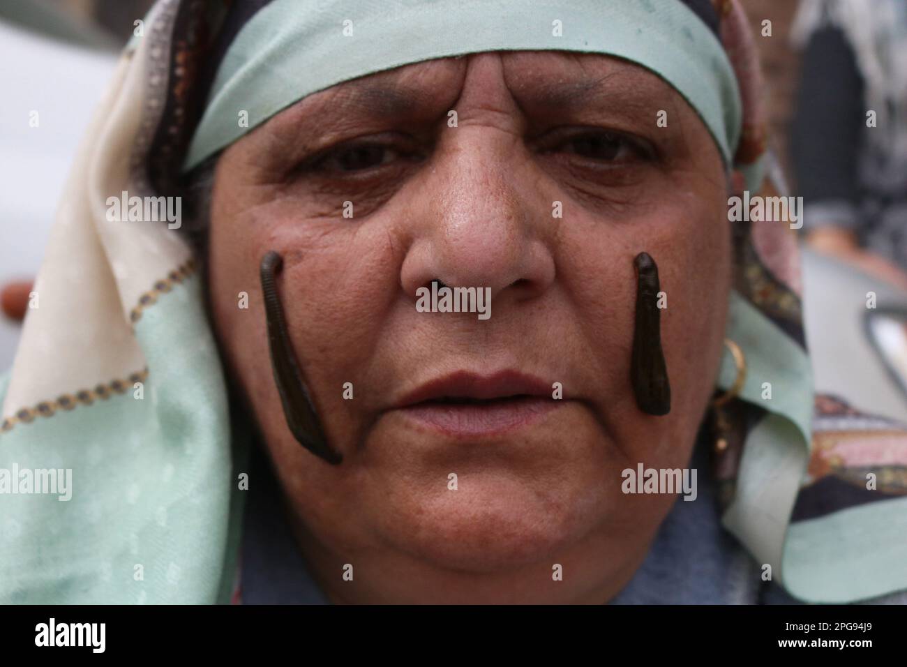 March 21, 2023, Srinagar Kashmir, India: Persons undergo a leech ...
