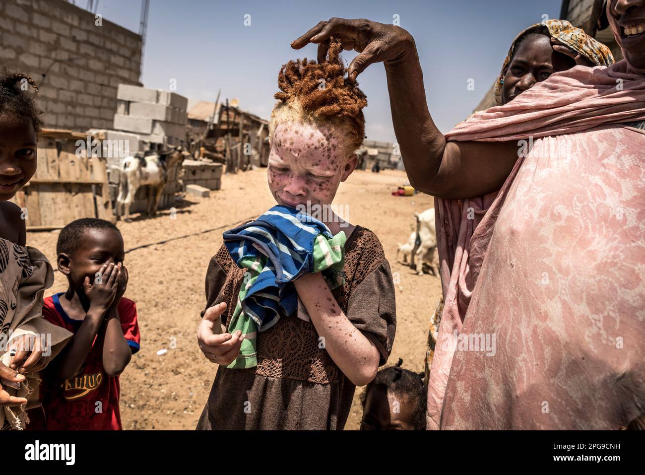 Albino girl in the poor district of Darnaim in Nouakshott, the capital ...