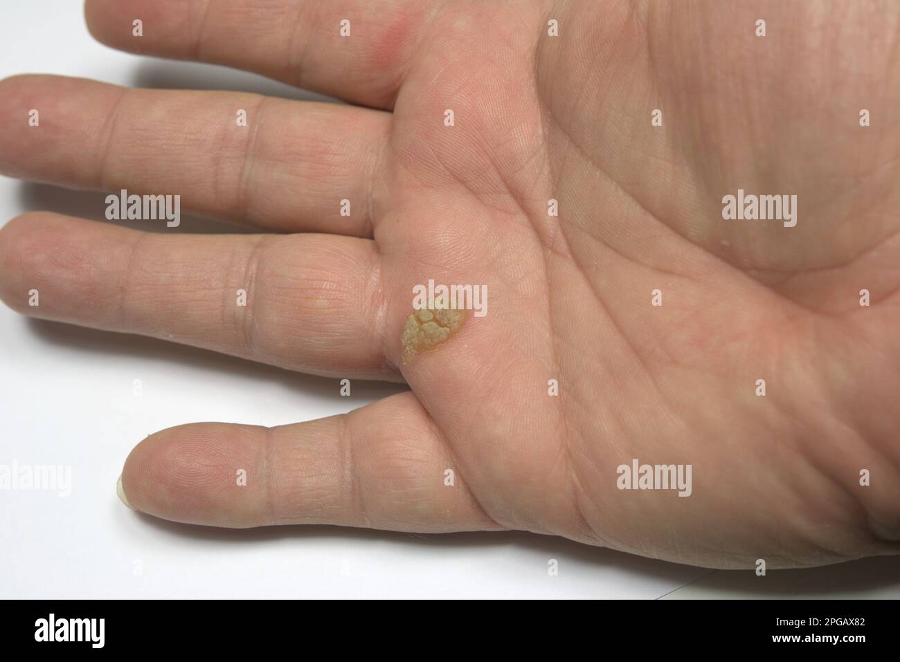 Wart In Palm Of Right Hand is 20 Years Old Stock Photo - Alamy
