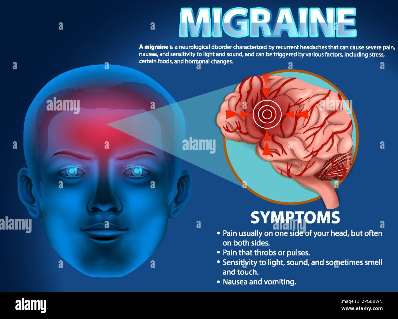 Informative poster of Migraine illustration Stock Vector Image & Art ...