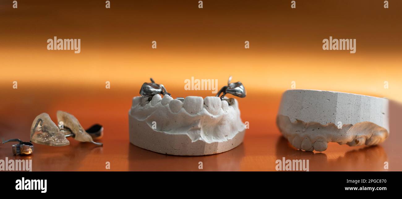 Dental models top view. Jaw models with different problems. Treatment ...