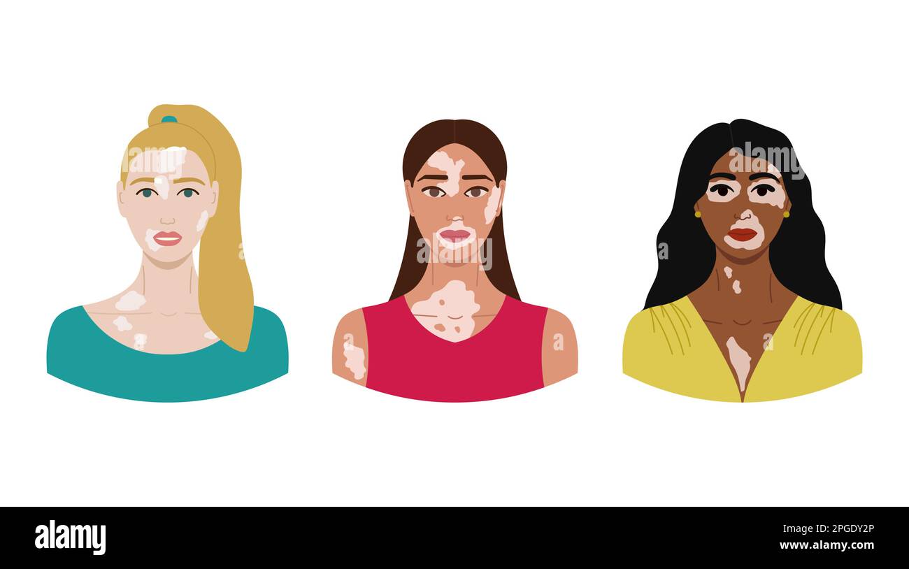 Set Of Female Faces With Vitiligo World Vitiligo Day Collection Of