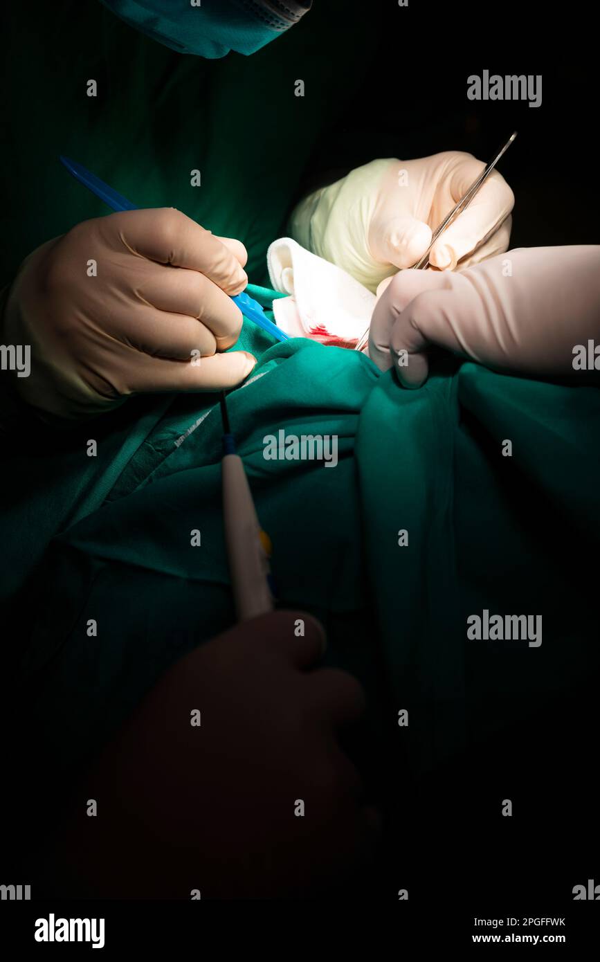 close-up of surgeon's hands operating on a dermatological lesion ...