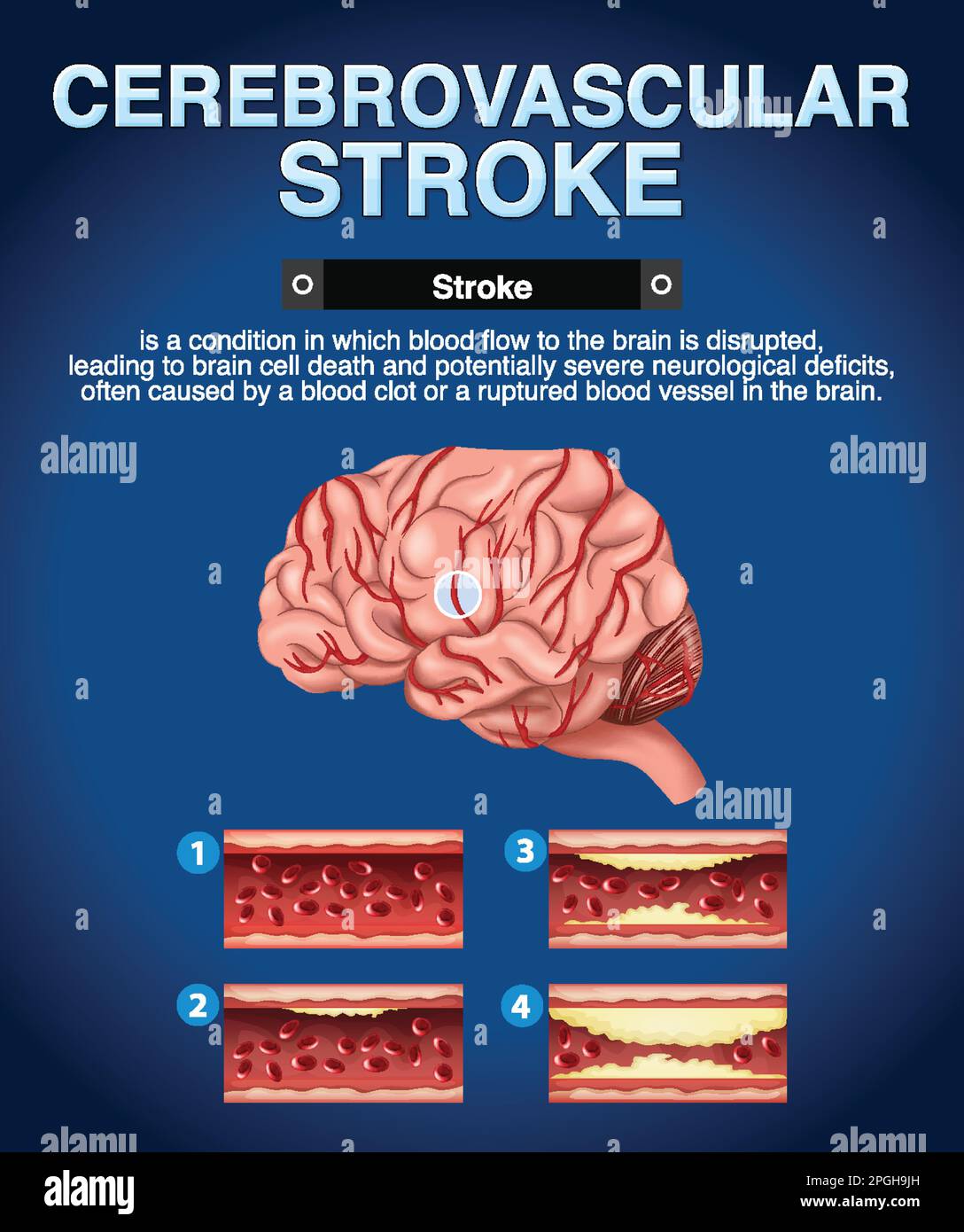 Informative poster of Cerebrovascular stroke illustration Stock Vector Image & Art - Alamy