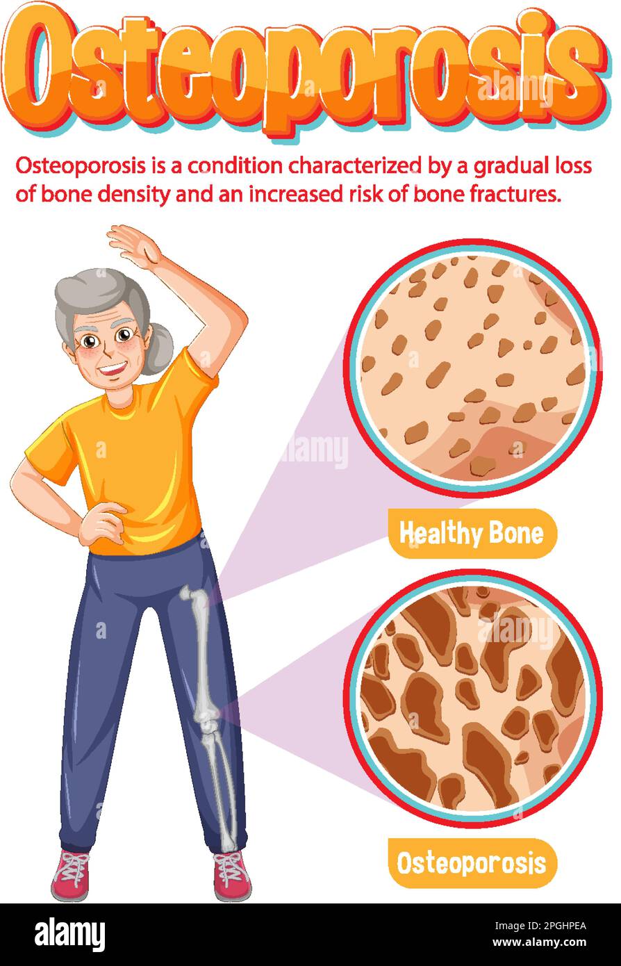Comparison of normal bone and bone with Osteoporosis in old people ...