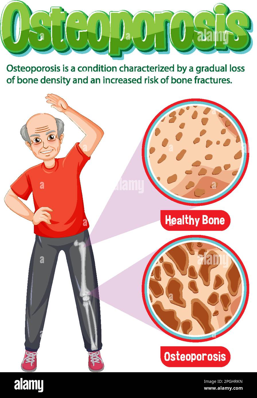 Informative poster of Osteoporosis human bone illustration Stock Vector ...