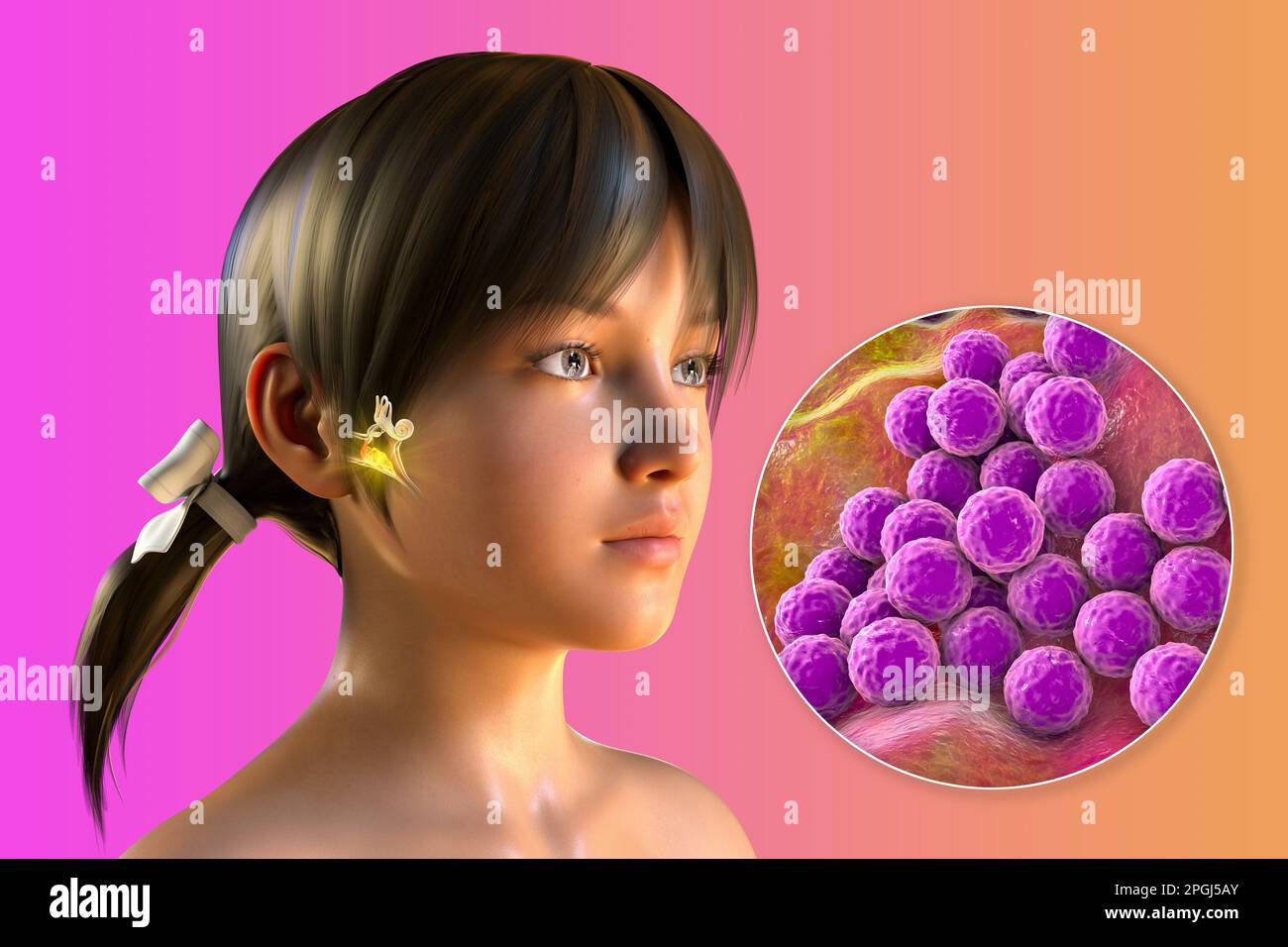 Chronic otitis media hi-res stock photography and images - Alamy