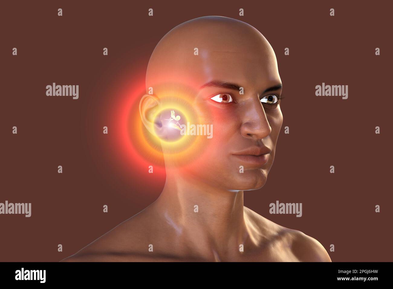 Chronic suppurative otitis hi-res stock photography and images - Alamy