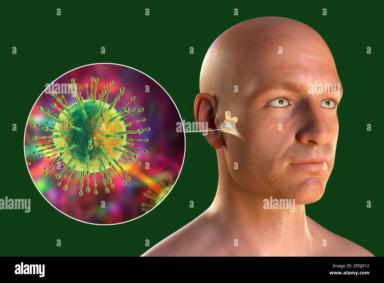 Ear diseases hi-res stock photography and images - Alamy