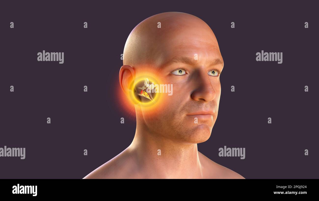 Chronic suppurative otitis hi-res stock photography and images - Alamy