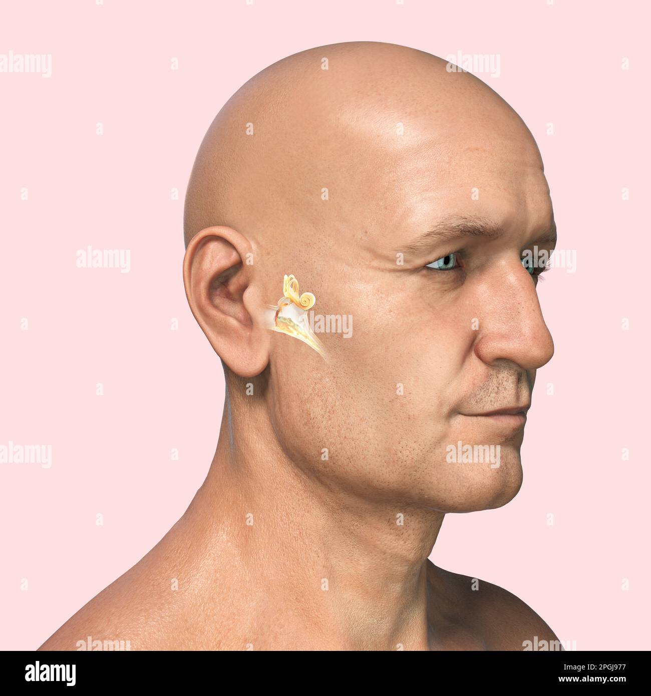 Chronic otitis media hi-res stock photography and images - Alamy