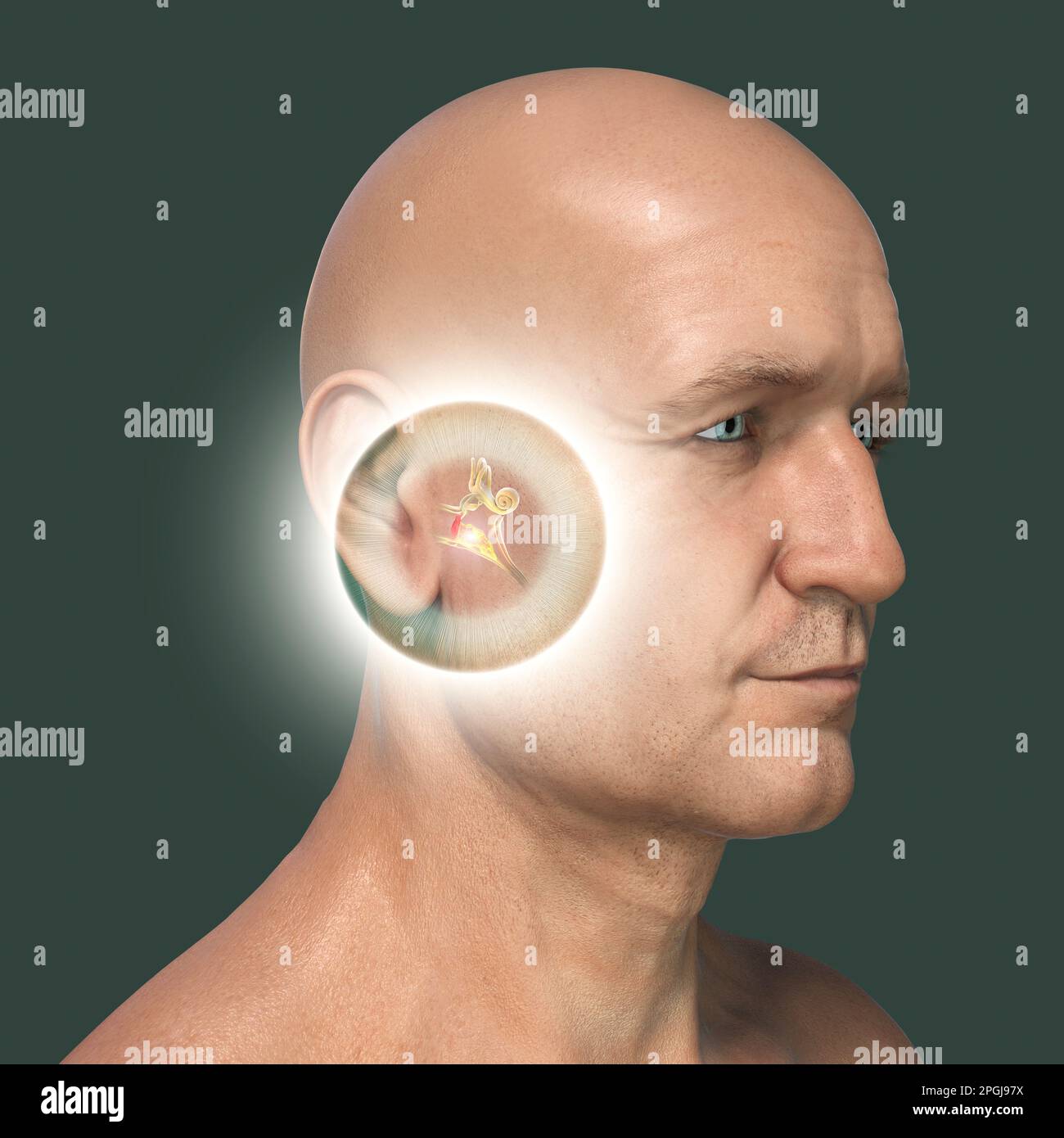 Chronic otitis media hi-res stock photography and images - Alamy