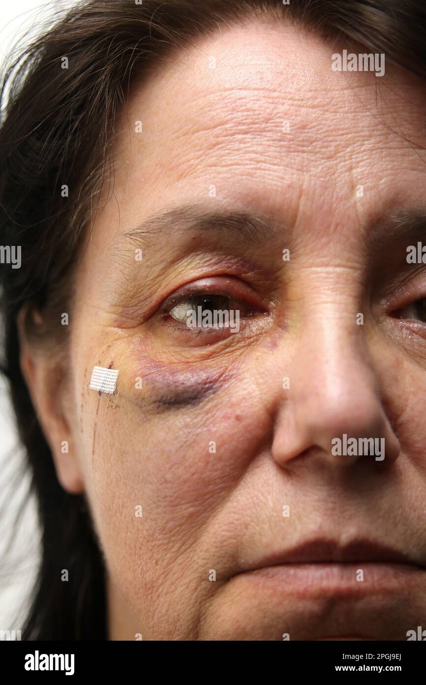 Black eye woman detail violence hi-res stock photography and images - Alamy