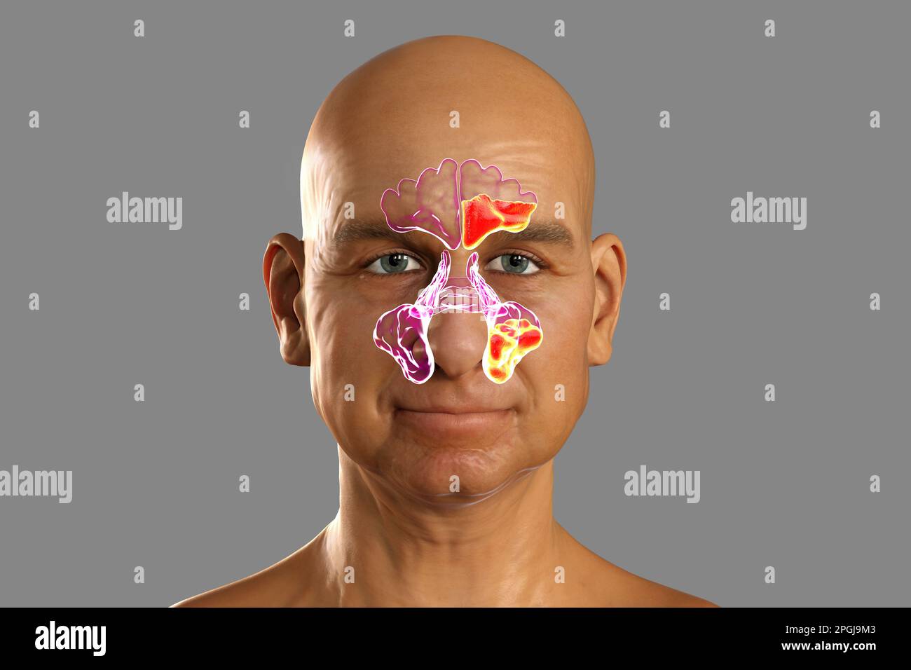 Sinus membrane hi-res stock photography and images - Alamy