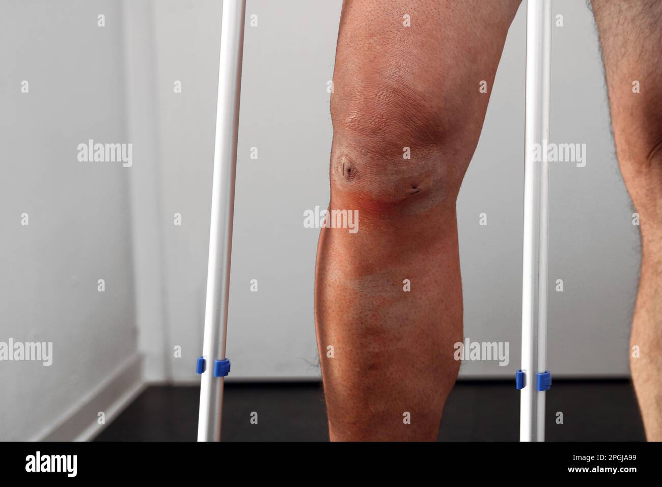 wound sutures after a knee surgery, meniscus repair Stock Photo - Alamy