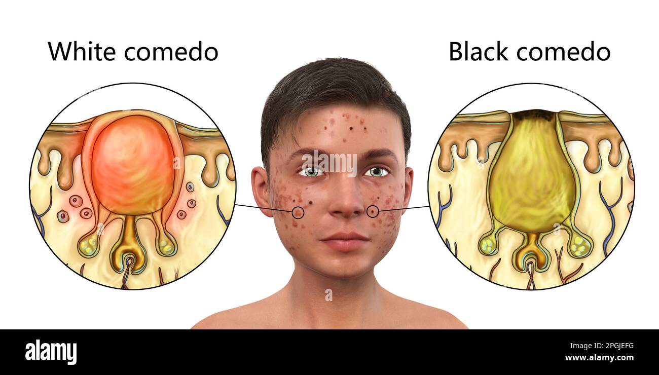 Black pustules hi-res stock photography and images - Alamy