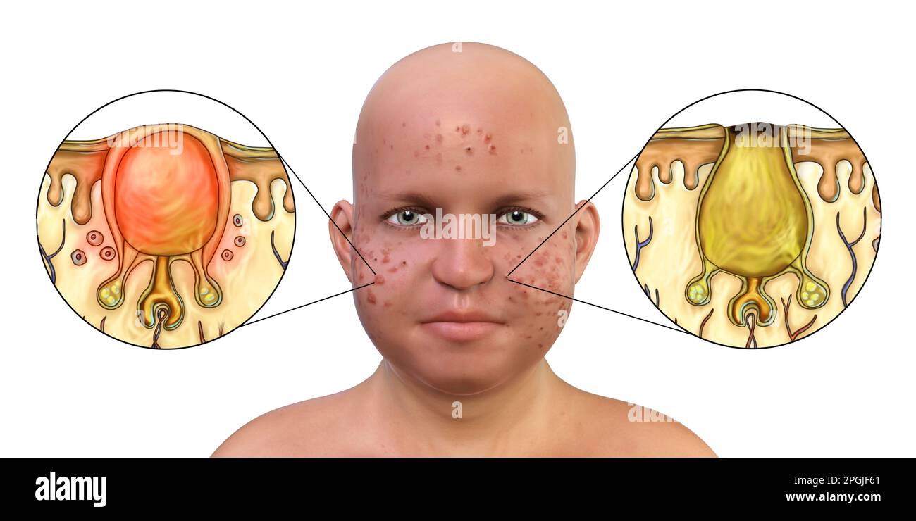 Black pustules hi-res stock photography and images - Alamy