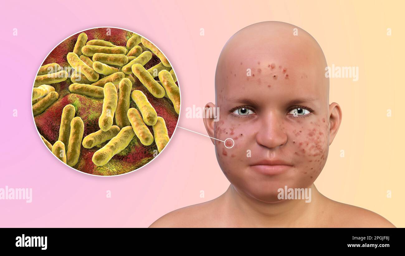 Propionibacterium acne hi-res stock photography and images - Alamy