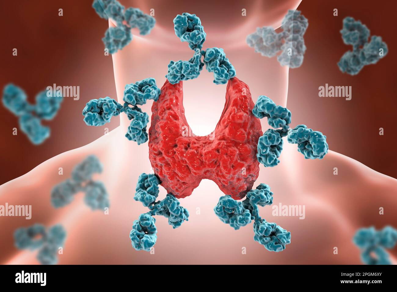 Hashimoto disease hi-res stock photography and images - Alamy