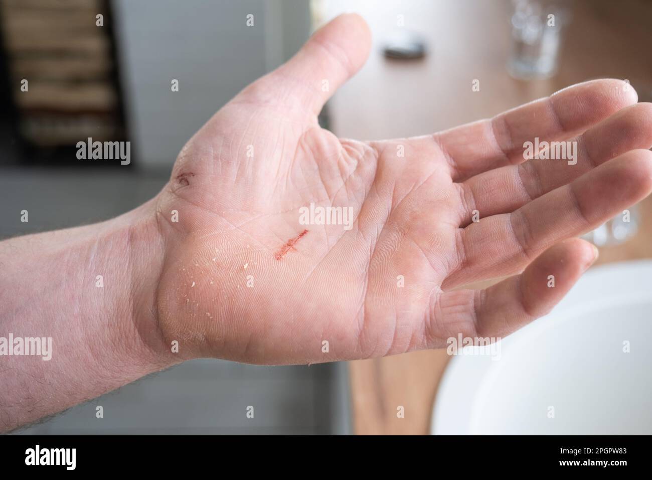 Skin damage hi-res stock photography and images - Alamy