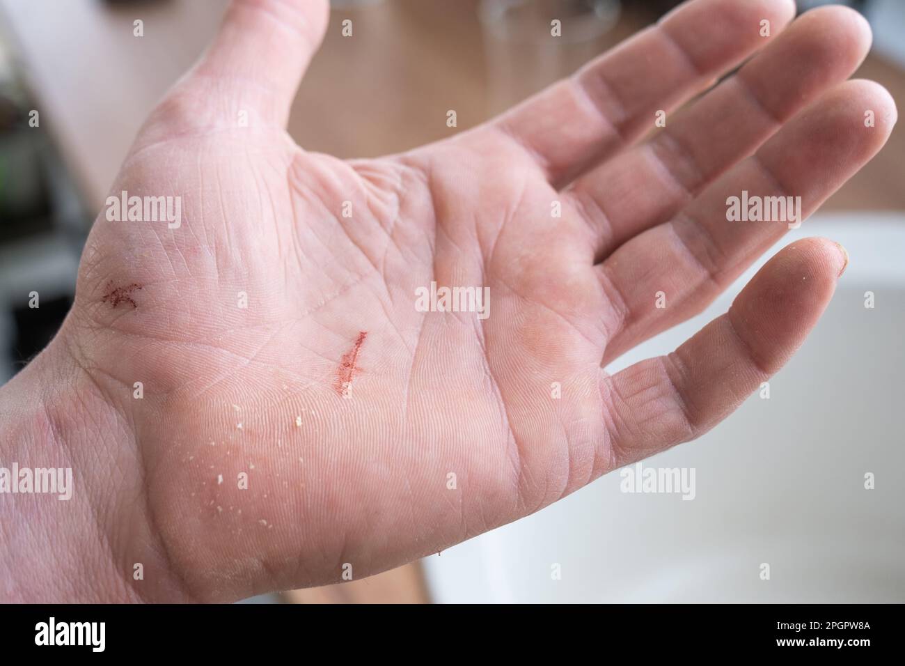 A cut on a man's palm in close-up. Household skin damage with a sharp ...