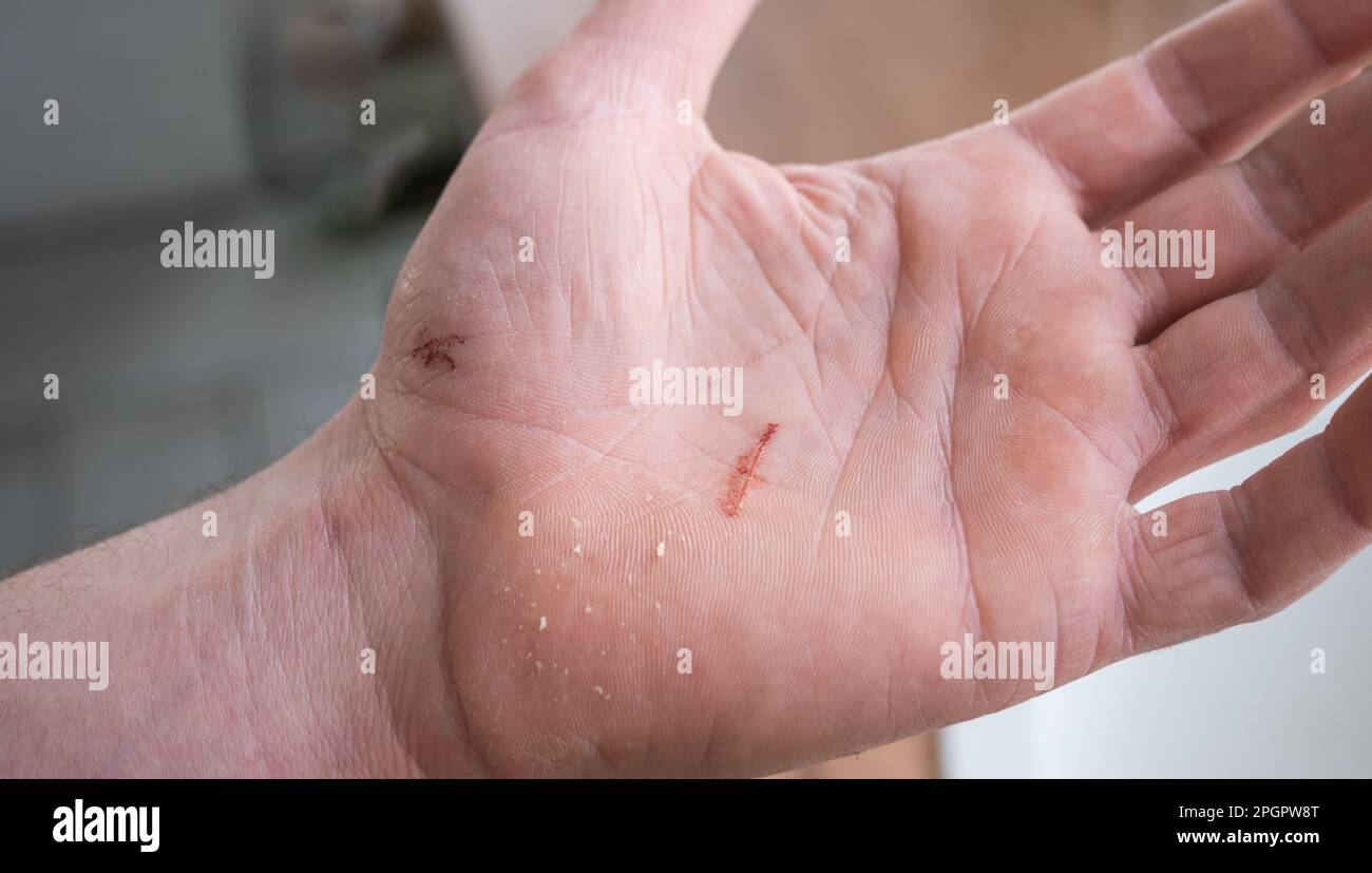 Skin damage hi-res stock photography and images - Alamy
