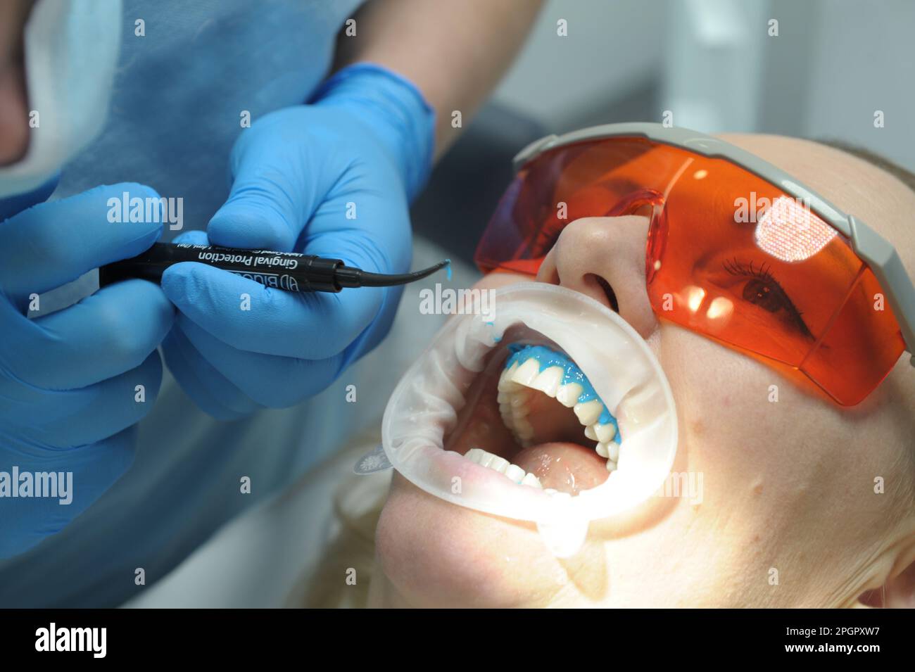 there is a preparation of the oral cavity to bleaching with the help of ...