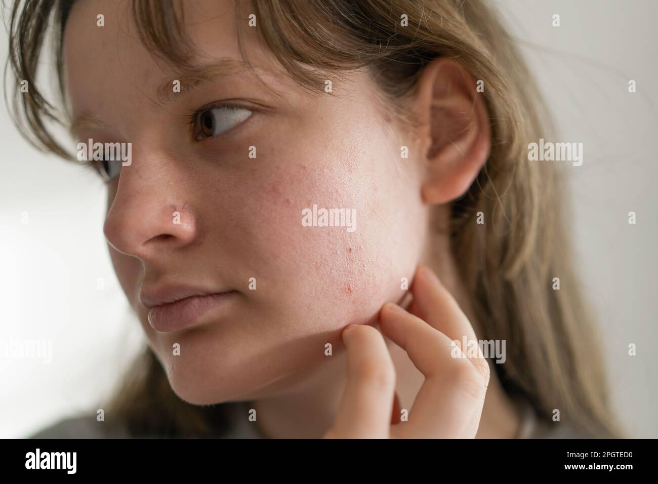 Problem skin face. A teenage girl with a troubled face Stock Photo - Alamy