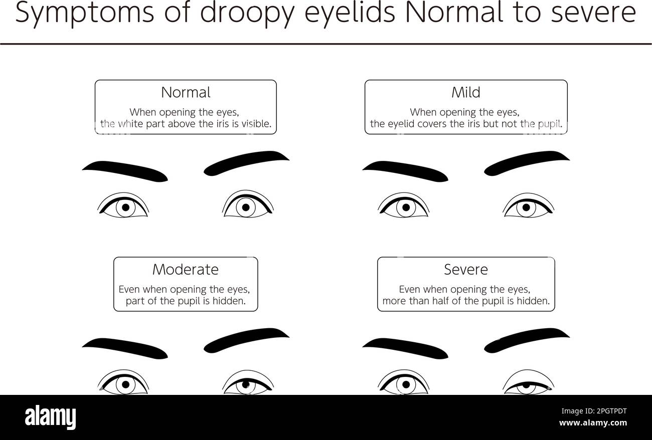 Medical Illustration, Ptosis Symptoms Normal to Severe - Translation ...