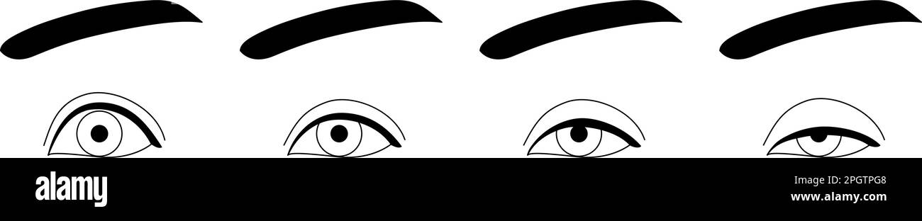 Medical Illustration, Ptosis Symptoms Normal to Severe - Translation ...