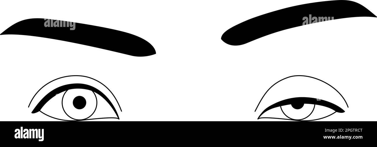 Medical illustration: Diagram of severe ptosis (eyelid drooping ...
