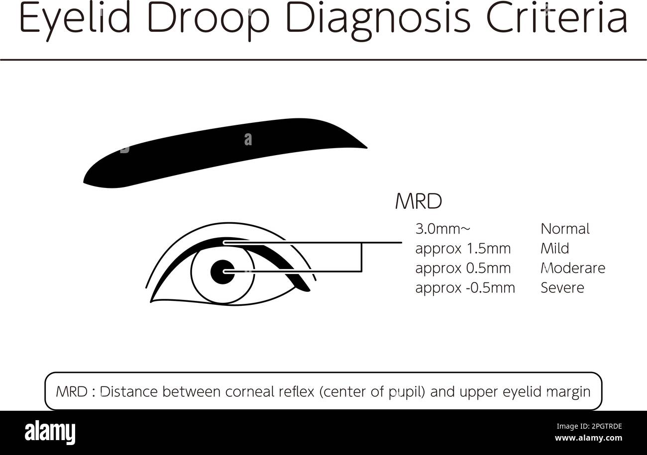 Medical illustration: Diagram of severe ptosis (eyelid drooping ...
