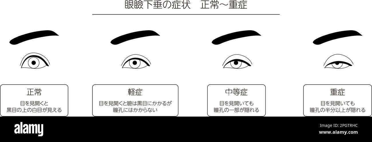 Medical Illustration, Ptosis Symptoms Normal to Severe - Translation ...