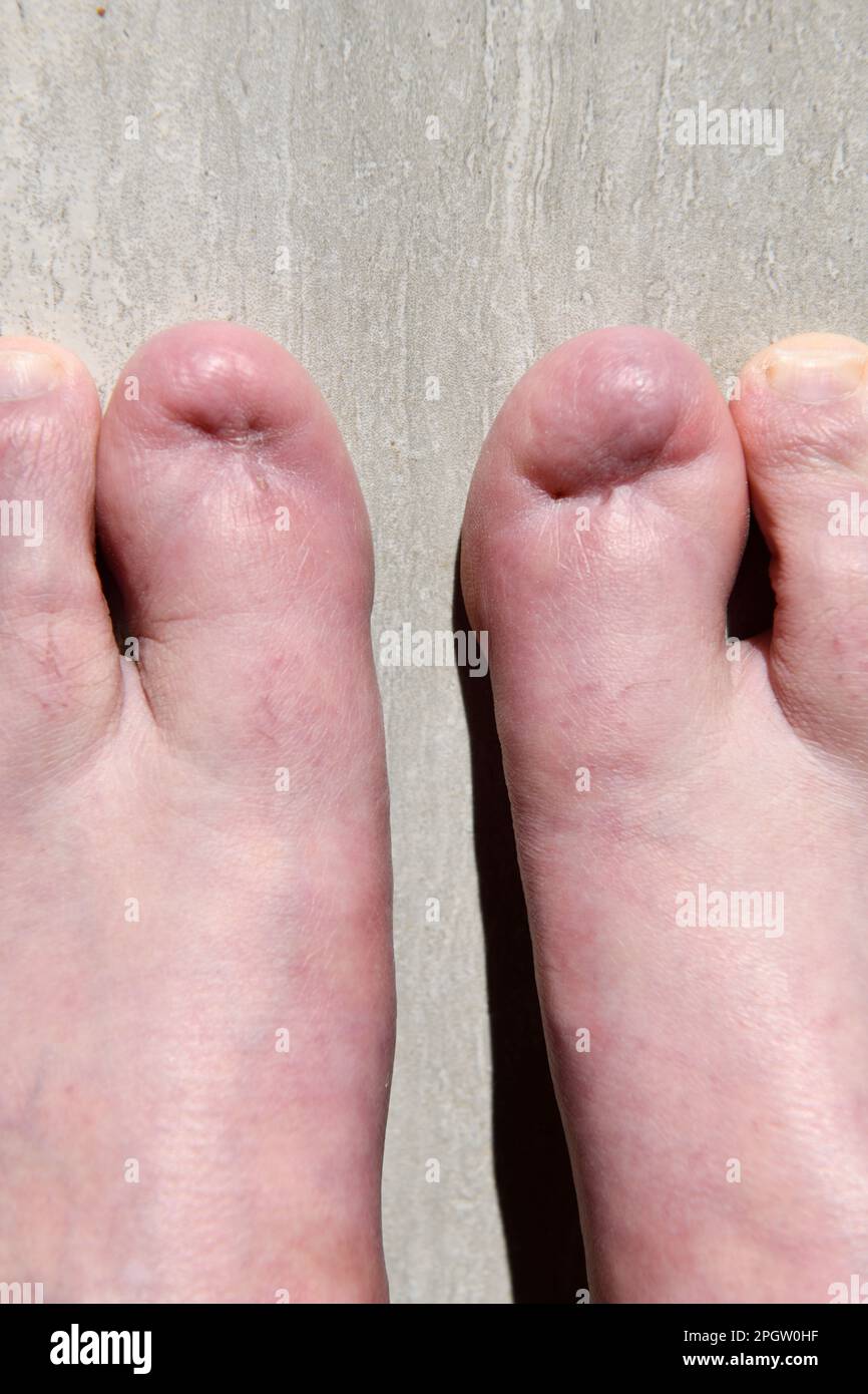 Ingrowing Toenails, Big Toes, Roots cut out Stock Photo - Alamy