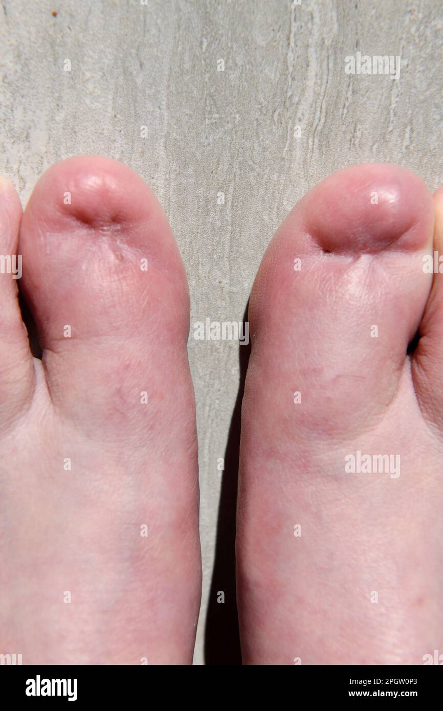 Ingrown toenails hi-res stock photography and images - Alamy