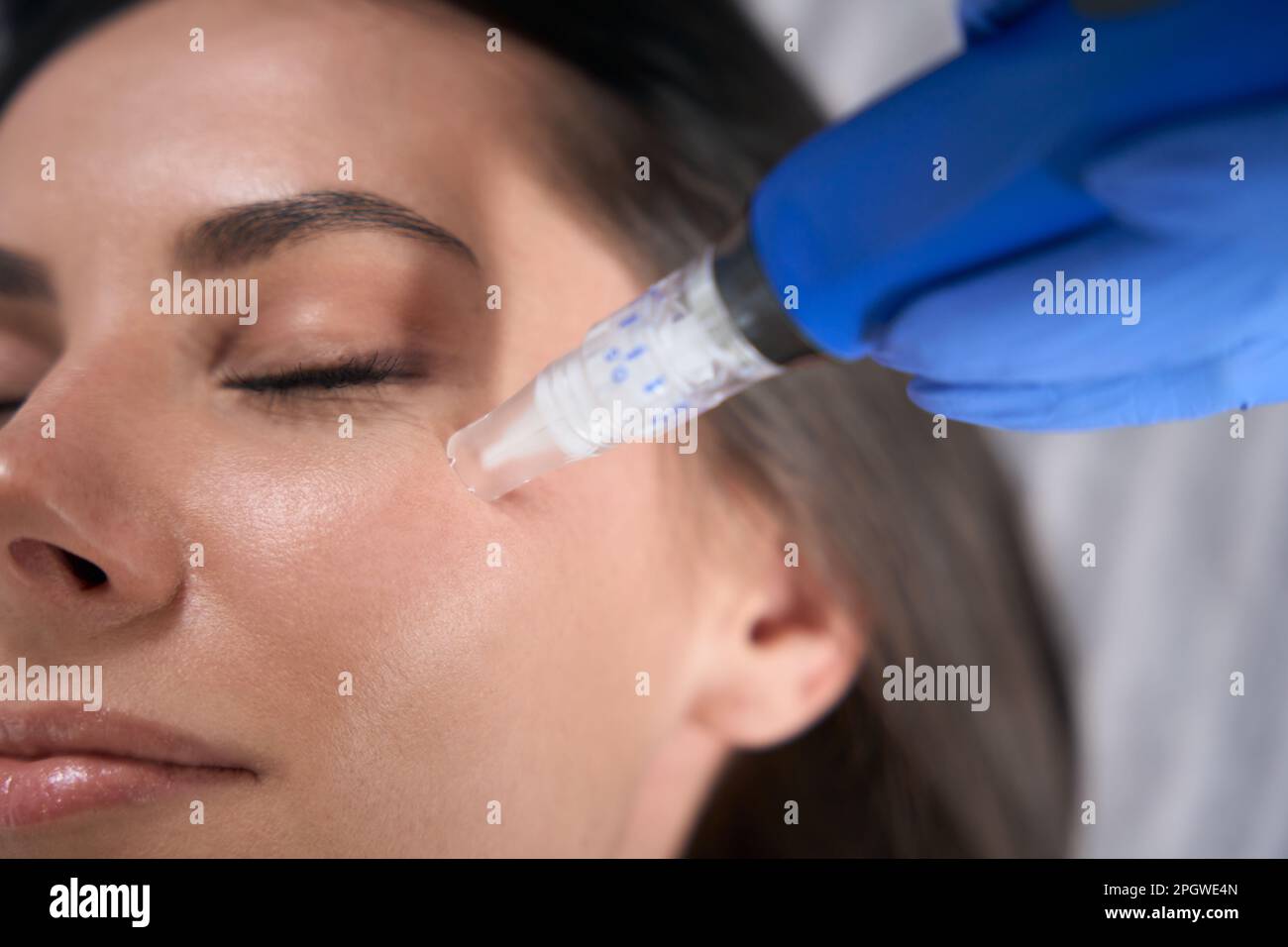 Woman holding device for high-precision micromechanical skin remodeling ...