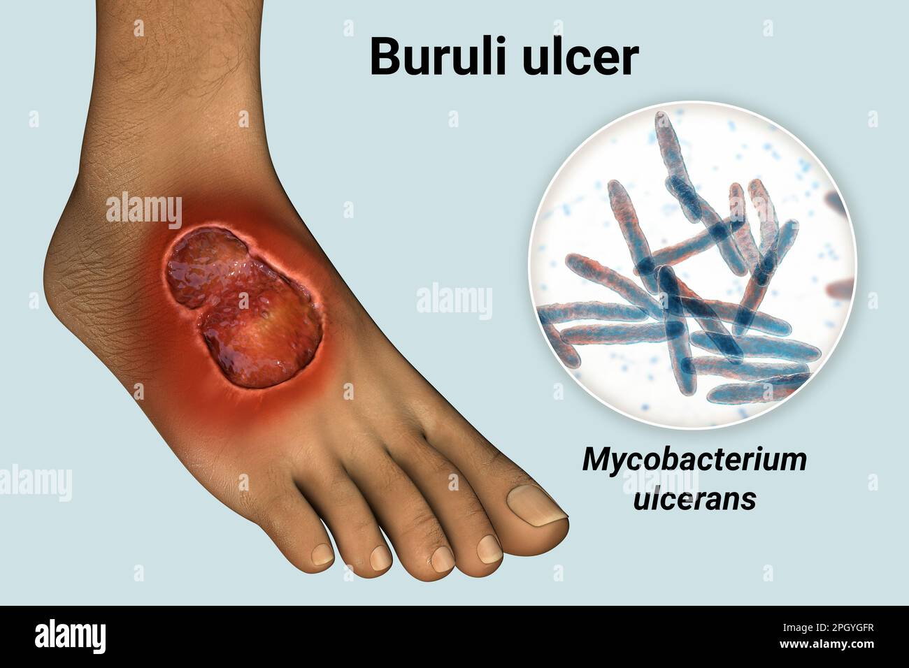Illustration Of A Buruli Ulcer On A Foot With A Close Up View Of Mycobacterium Ulcerans The