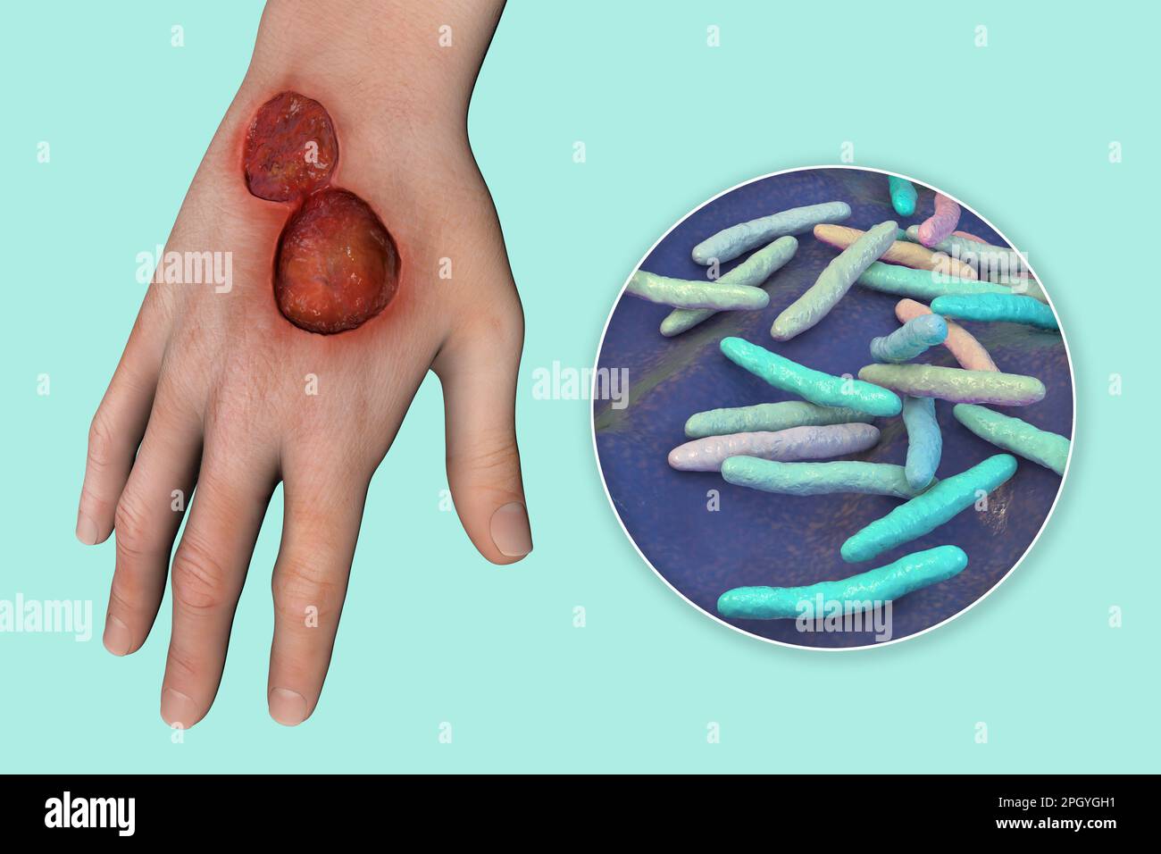 Buruli ulcer and Mycobacterium ulcerans, illustration Stock Photo - Alamy