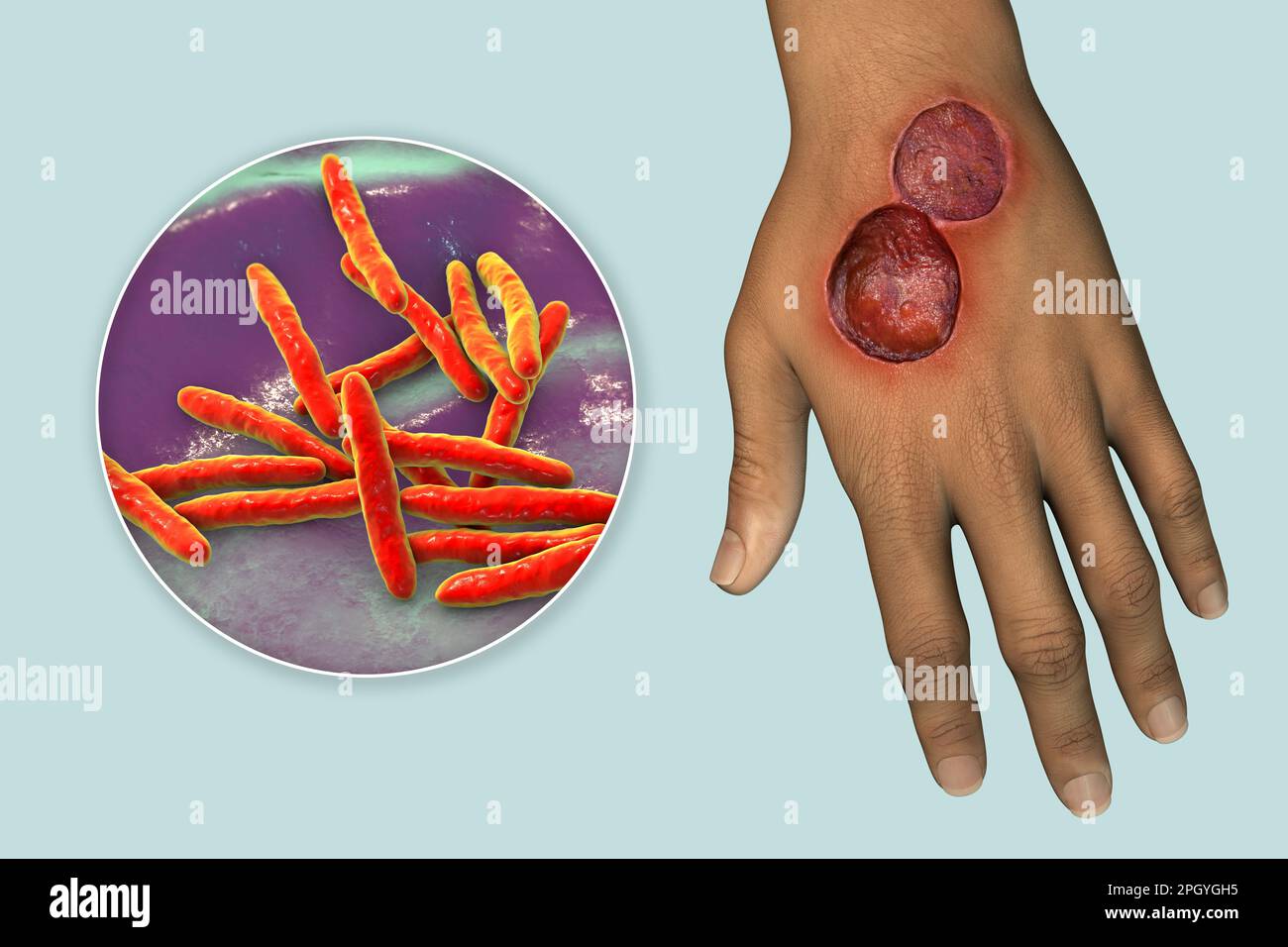 Illustration of a buruli ulcer on a hand with a close-up view of ...