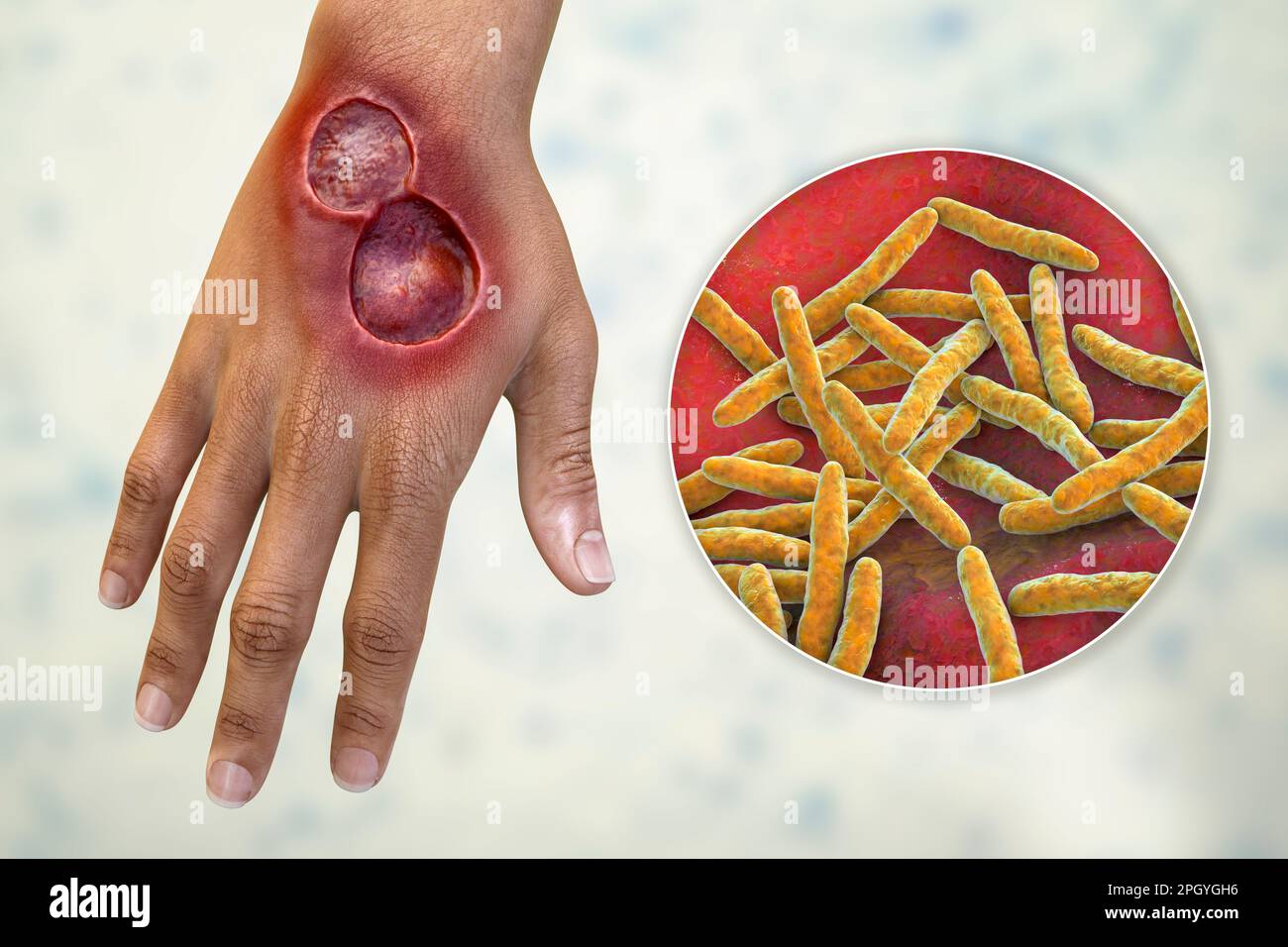 Illustration of a buruli ulcer on a hand with a close-up view of ...
