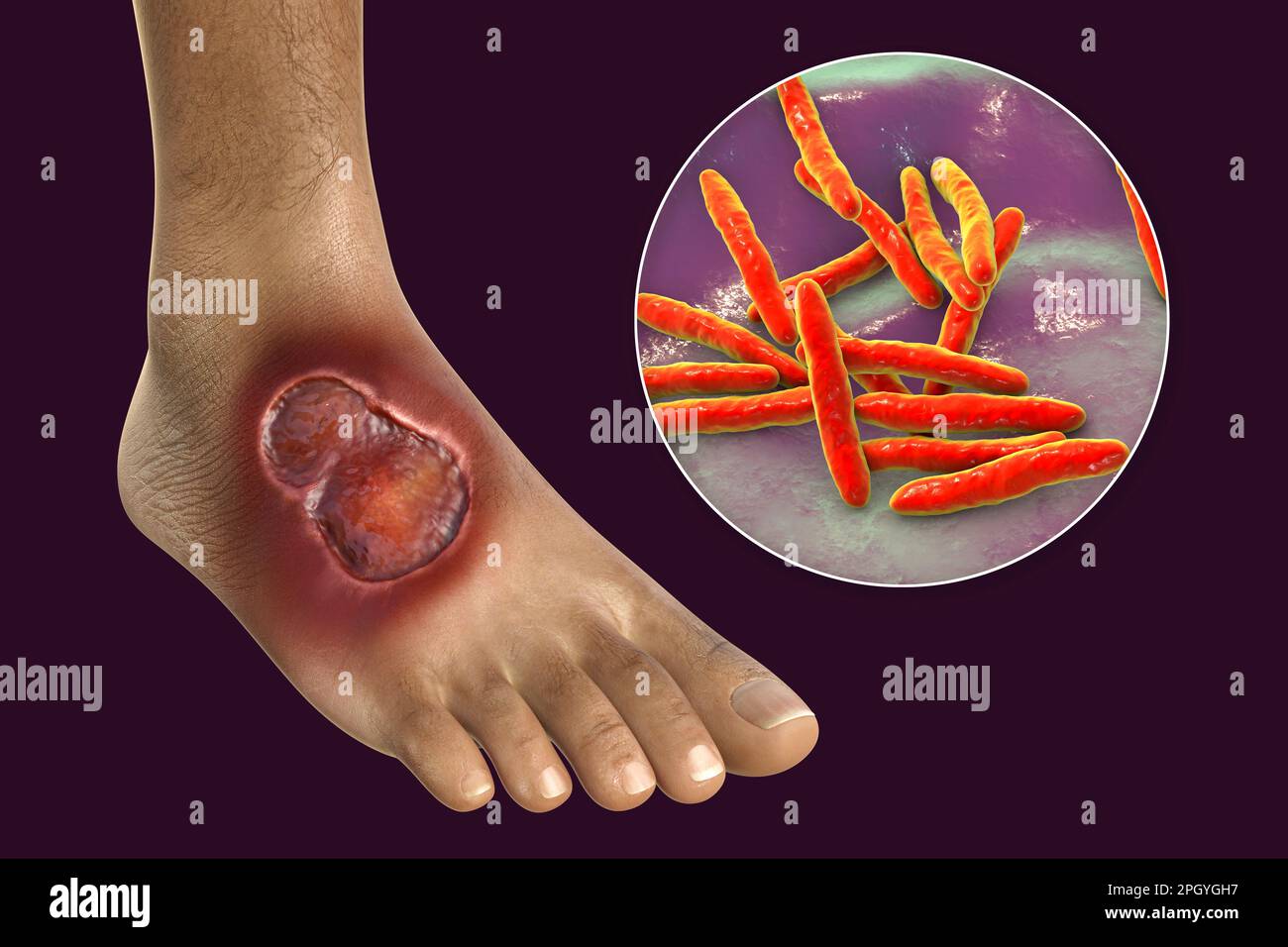 Buruli ulcer and Mycobacterium ulcerans, illustration Stock Photo - Alamy
