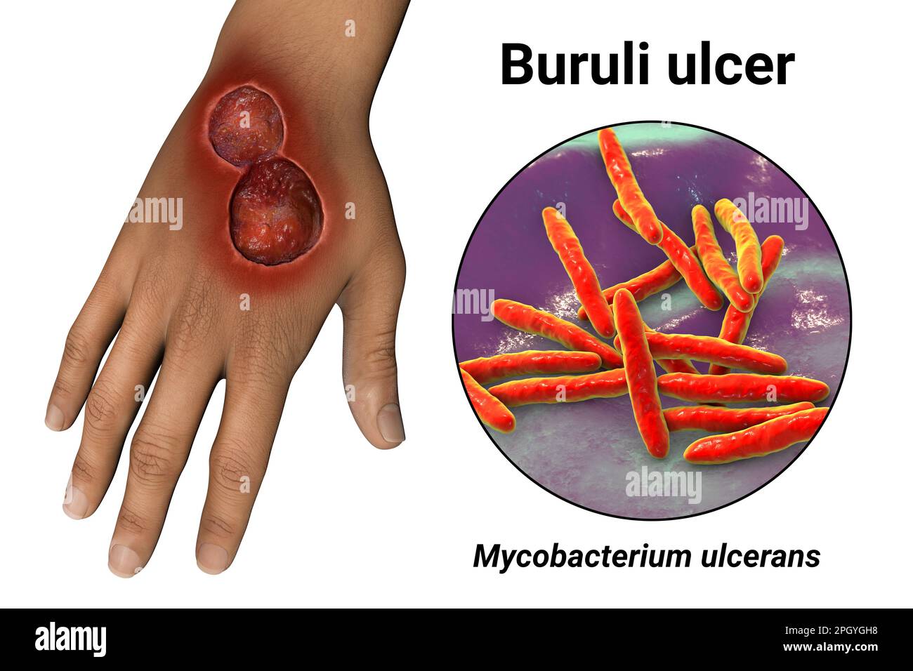 Buruli ulcer and Mycobacterium ulcerans, illustration Stock Photo - Alamy