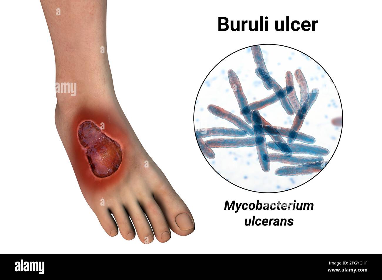 Illustration of a buruli ulcer on a foot with a close-up view of Mycobacterium ulcerans, the ...