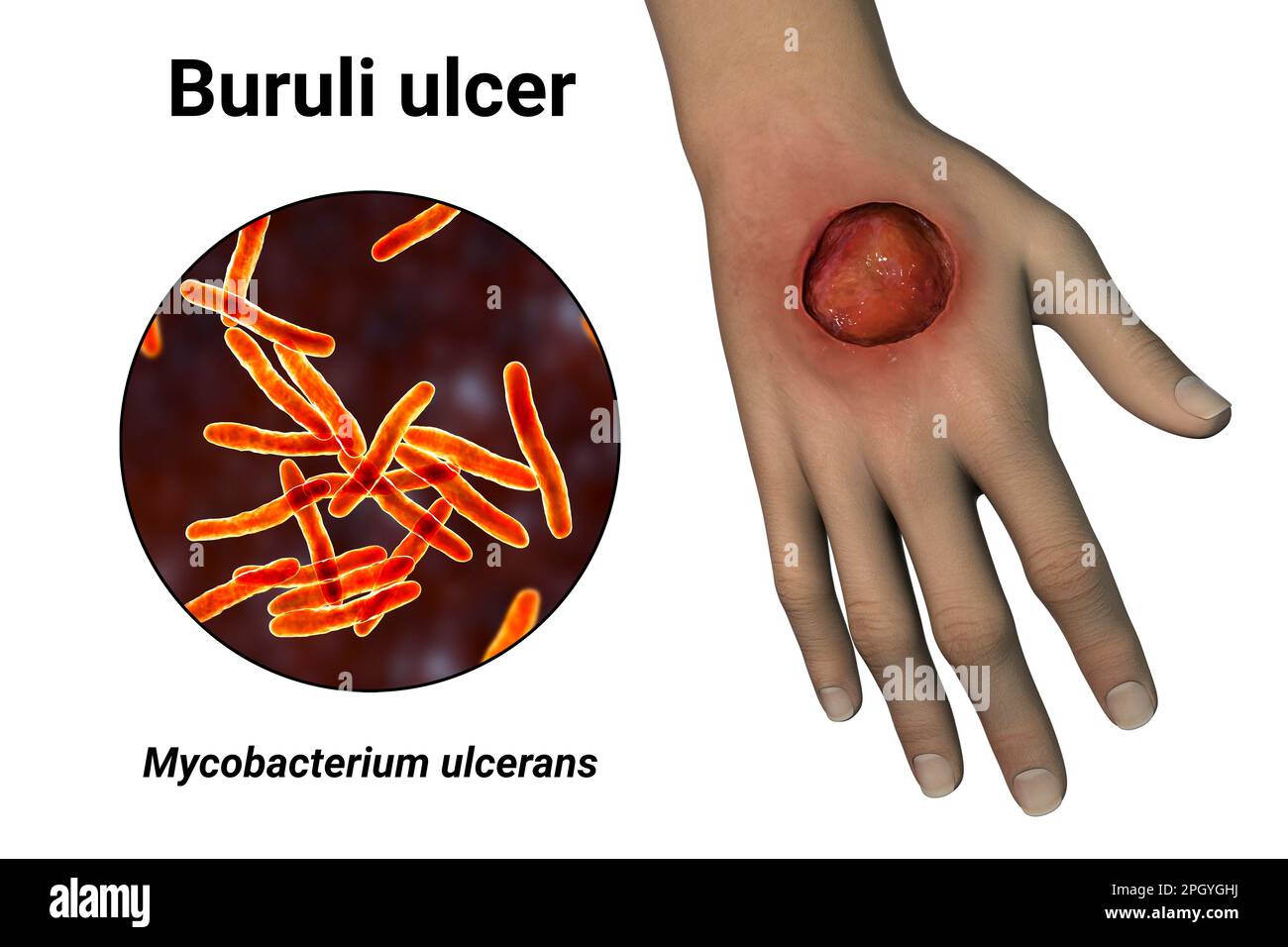 Illustration of a buruli ulcer on a hand with a close-up view of ...